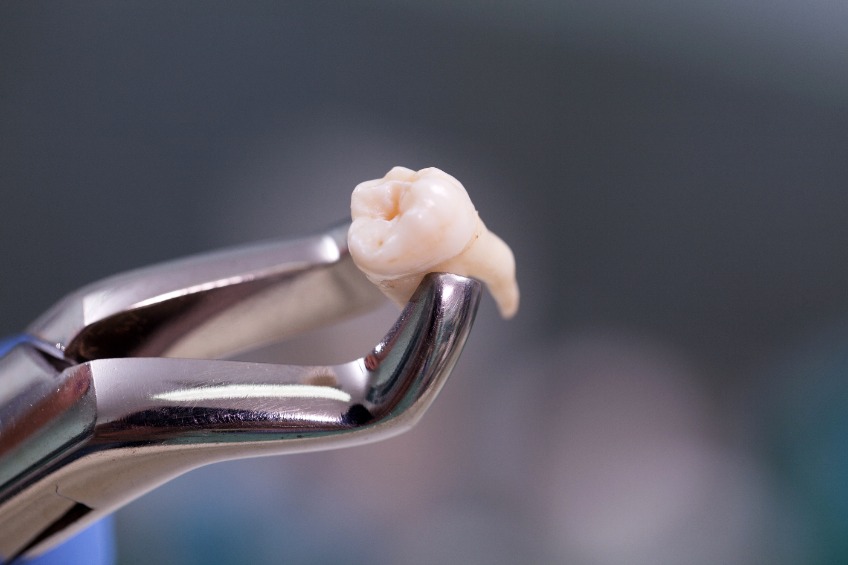 The Definition Of A Wrong Tooth Extraction And Claiming Compensation ...